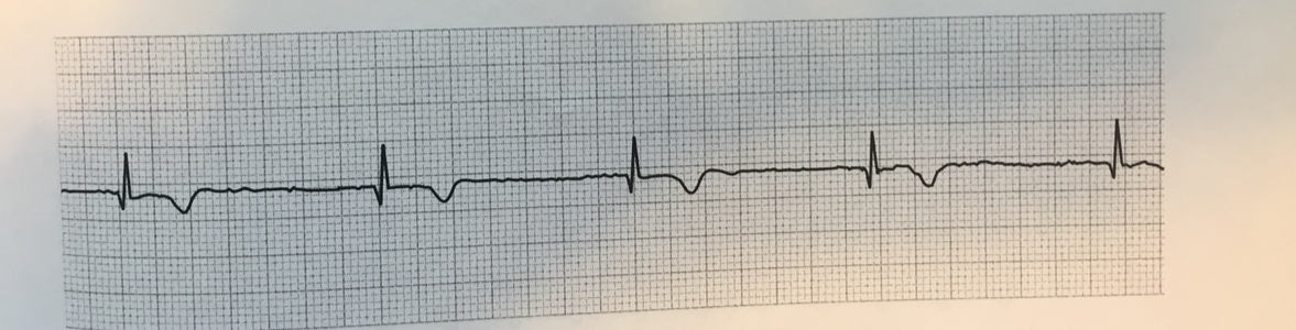 Question 4 Application of EKG in the Clinical Setting PhysicalTherapy ...