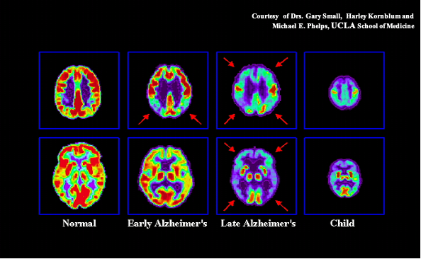 Dementia Management: Techniques for Staging and Intervention - Article 4763